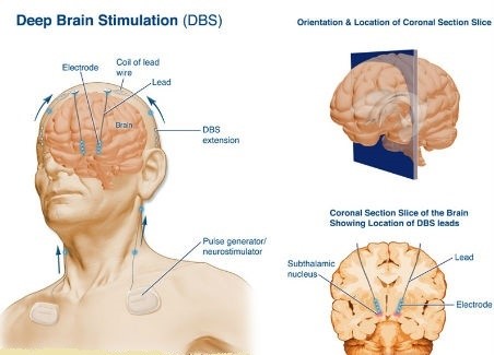 DBS – Deep Brain Stimulation » Apex Medical Tourism